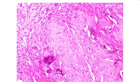 HE Focal Areas Of Osseous Metaplasia Download Scientific Diagram