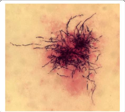 Gram Stain Of Aspirate From Pleural Effusion Gram Stain Of Aspirate