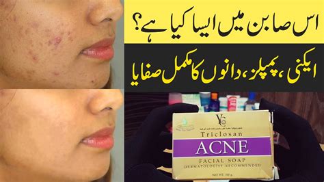 Acne Pimples Simple Solutions A Treatment Urdu Hindi YouTube