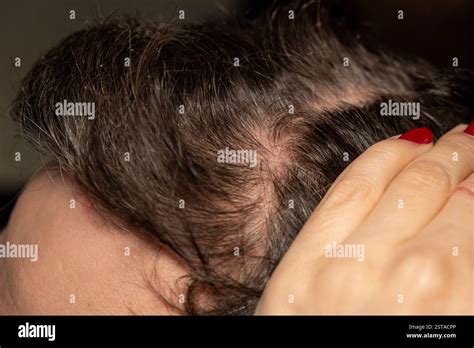 Scalp Psoriasis Characterized By Red Patches And Scaly Skin Highlighting A Common Genetic Immune