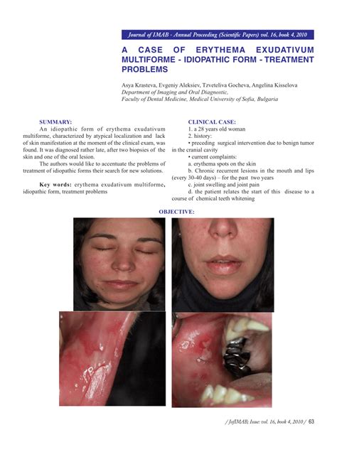 Pdf A Case Of Erythema Exudativum Multiforme Idiopathic Form