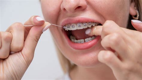 Guide To Flossing With Braces Methods Tips And More For Optimal Oral Hygiene