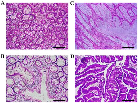 Deep Learning Techniques For Detecting Preneoplastic And Neoplastic Lesions In Human Colorectal