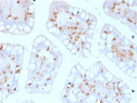 Cd103integrin Alpha E T Cell Lymphoma And Hairy Cell Leukemia Marker