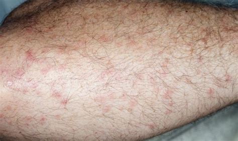 How To Prevent Gnat Bites The 4 Tips Uk