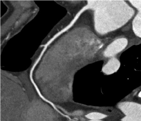 Coronary Segment Image Download Scientific Diagram