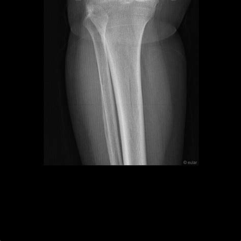 X Ray Of The Wrist Calcifications Of The Tfcc Asterisks By Cppd Download Scientific Diagram X Ray Of The Wrist Calcifications Of The Tfcc Asterisks By Cppd Download Scientific Diagram