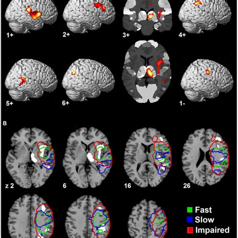 Spatial Topography Of Longitudinal Structural Covariance Network