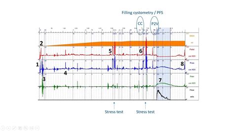 Ics 2021 Workshop 10 Basic Urodynamics An Interactive Workshop