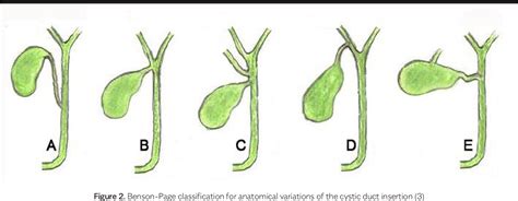 Figure 1 From A Rare Anatomical Variation Of The Bile Ducts Cystic