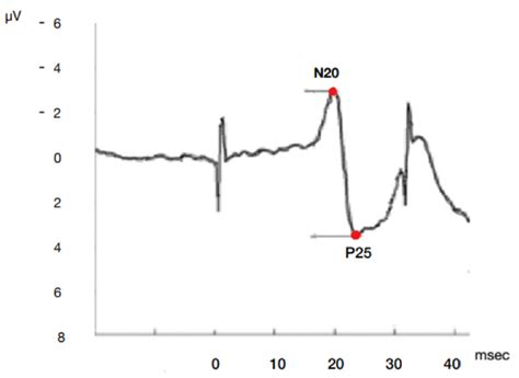 Model Of Ssep N20p25 Cortical Complex Wave Onset And Peak Amplitude And