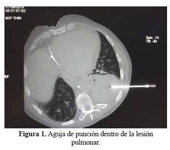 Ser amado malo Ligero biopsia guiada por tac Puntero Qué eso es todo