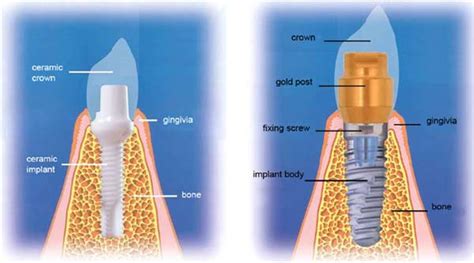 Best Dental Implants In Brookline Ma Titanium And Zirconia Implants