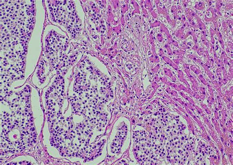 140 Neuro Endocriene Tumor Fotos Stockfotos Afbeeldingen En Royalty