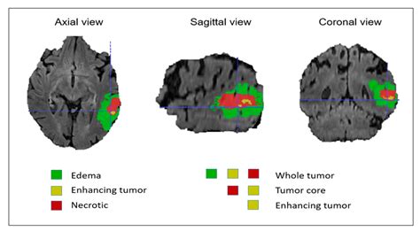 Multi Task Learning For Small Brain Tumor Segmentation From Mri