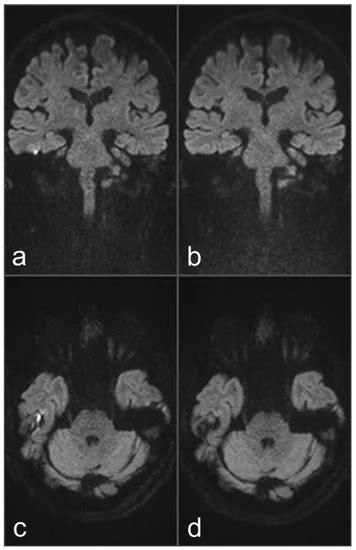 Neues Papier Comparison Of Diagnostic Performance And Image Quality Between Topup Corrected And