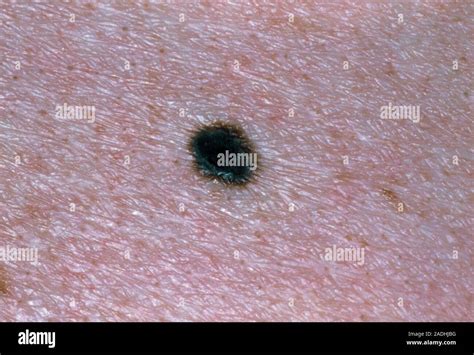 Lentigo Close Up Of Skin Showing Lentigo Also Called Age Spots Or