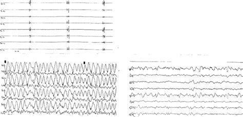 sequential eeg recording a flat eeg with burst suppression at