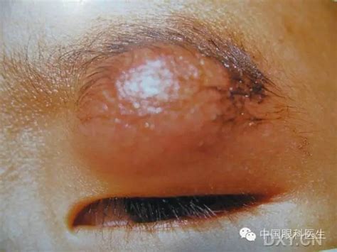 眼疮症状图片大全 长眼疮症状图片 疥疮图片和症状图片 大山谷图库