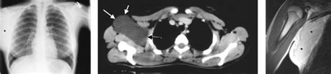 Right Axillary Cystic Hygroma Age 11 Initial Posterior Anterior