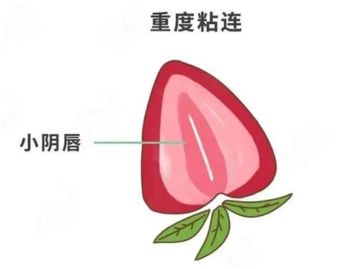 什么情况下需要做阴唇整形手术？ 知乎