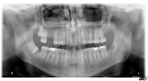 Case Of The Week Mucous Retention Pseudocyst Dr G S Toothpix