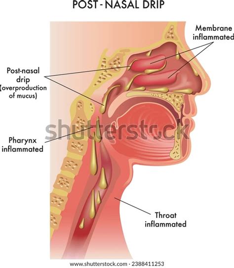 Nasal Drip Vs Post Nasal Drip At Rufina Brown Blog