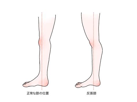 体が柔らかければ良い？女性に多い関節弛緩性って何？ Yuruku®️ウォーク 姿勢改善・歩き方矯正教室