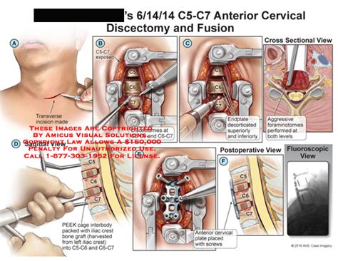 Amicus Illustration Of Amicussurgeryc5c6c7anteriorcervical