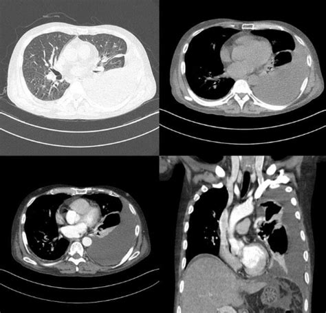 폐 Ct 흉부 Ct 검사 1종류 2검사 방법 3비용과 4국가검진 절차