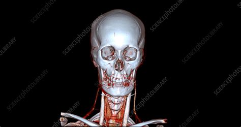 Head And Neck Ct Angiogram Stock Image F046 0977 Science Photo Library