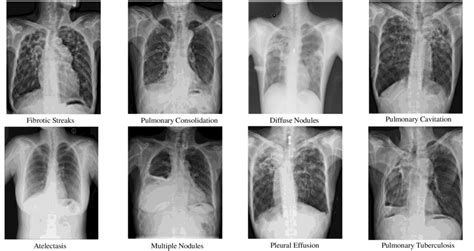Sample Chest X Ray Images Used For Building The Tb Xatt Dataset Each
