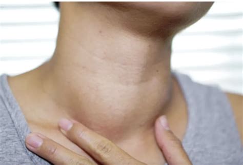 Thyroid Nodules Symptoms Causes Treatment My Healthy Diet