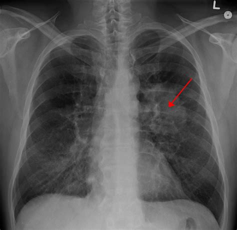 Chest X Ray Interpretation A Structured Approach Radiology Osce