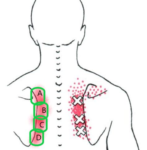 Rhomboid Trigger Point Triggerpoint Therapy Treating The Rhomboids