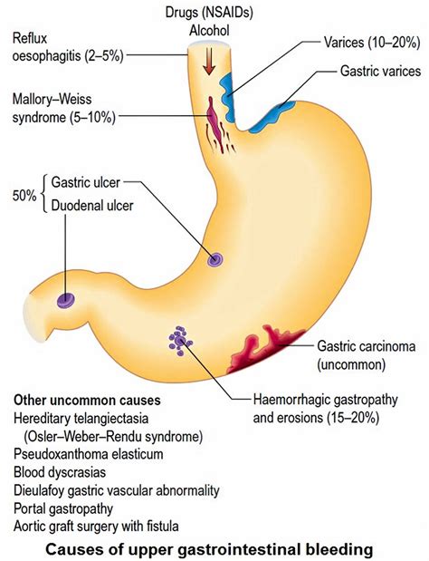 Melena Stool Definition Causes Symptoms Diagnosis And Melena Treatment