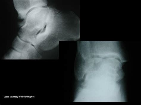 Ppt Ankle Impingement Syndromes Powerpoint Presentation Free