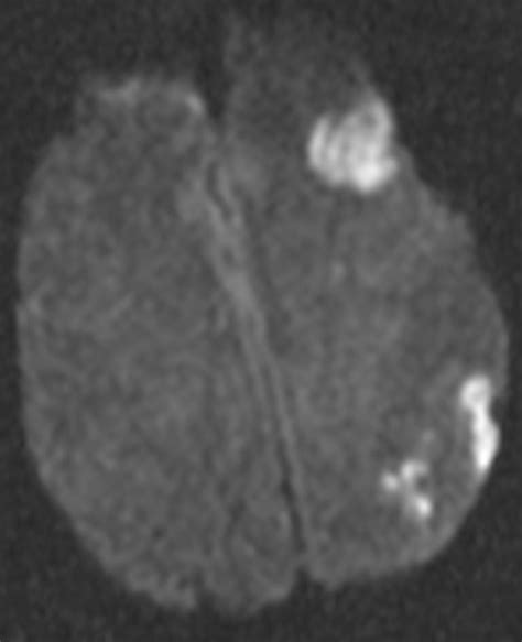 Left Modified Orbitozygomatic Approach To Multiple Aneurysms Cns Org