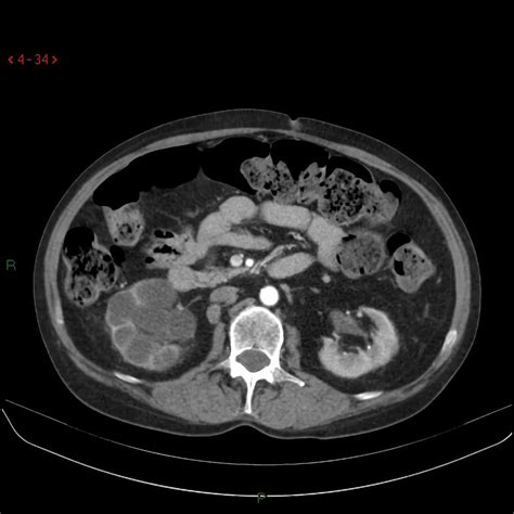 Recommandations Sur Linsuffisance Rénale Aiguë Ira Recomédicales
