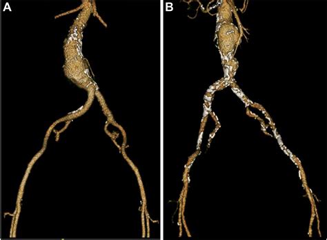 Effect Of Doxycycline On Progression Of Arterial Calcification In The Noninvasive Treatment Of