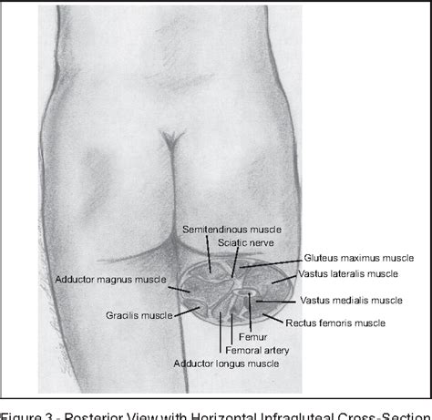 Figure 3 From Simplified Sciatic Nerve Approach By The Posterior Route