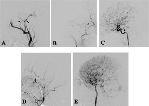 Angiograms Of The Right Internal Maxillary Artery A Right Oa B