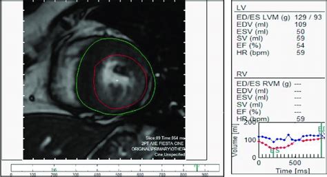 Segmentation Of The Left Ventricle And Extraction Of Cardiac Download Scientific Diagram