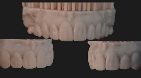 Using 3d Wax Ups In Gingivectomy Cases Clinical Analysis And 3d