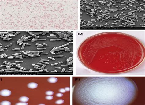 Aggregatibacter Actinomycetemcomitans Focus Dentistry