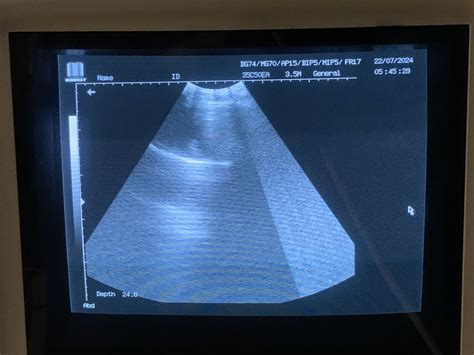 Mindray 35C50EA Convex Array Ultrasonic Transducer Genuine AusChoice
