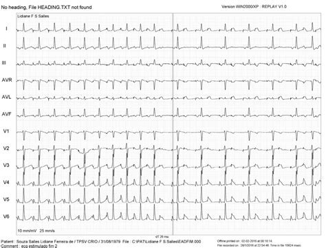 Electrocardiography 45 Minutes After Ablation During Atrial