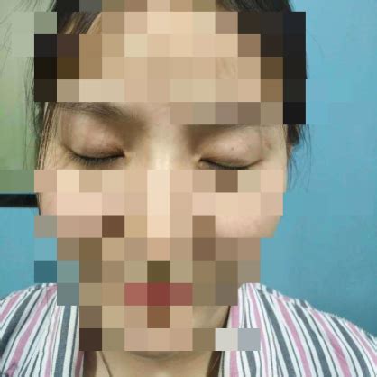 双眼皮手术有后遗症吗 知乎