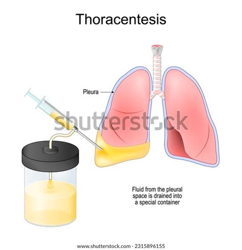Thoracentesis Thoracentesis Understanding Uses Procedure And