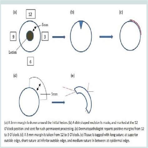 Example Of Serial Staged Excision Technique Investigated Download Scientific Diagram